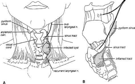 Sporadic Painless Painful Subacute And Acute Infectious Thyroiditis