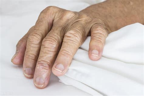 李俊才医生治疗硬皮病效果怎么样？ 公益新闻 中国文艺报道