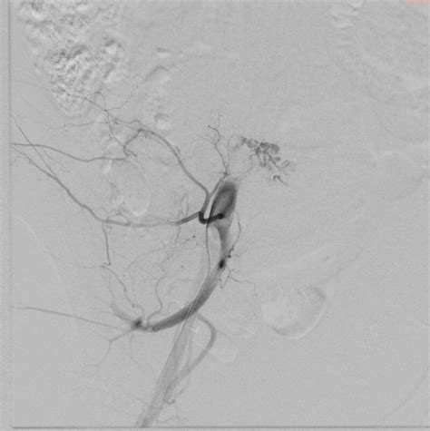 Koka Gogichashvili On Linkedin This Is About The Clinical Case Of Inr Onyx Glue In The