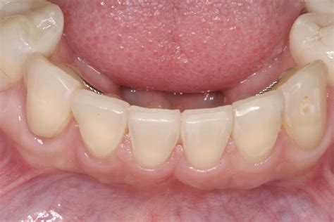 Leading And Trailing Edges Part 2 The Pankey Institute