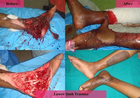 Lower Limb Reconstruction Bembde Hospital