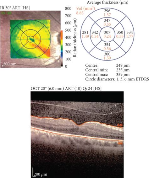 Clinical Features Of The Patient At The Time Of Presentation Bilateral Download Scientific