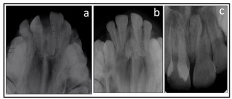 Occlusal Radiograph Showed One A And Two B Inverted Supernumerary