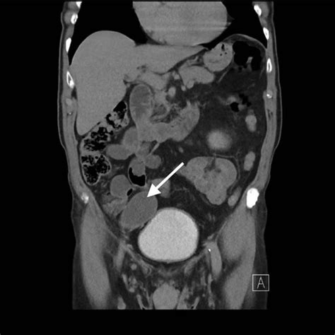 Colonoscopic Findings Of The Orifice Of Appendix A Colonoscopy Download Scientific Diagram