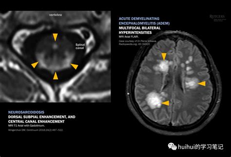 脊髓疾病的症状诊断治疗大总结 MedSci cn