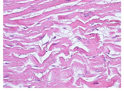 Diffuse Interstitial Fibrosis And Findings Of Multifocal Disarray
