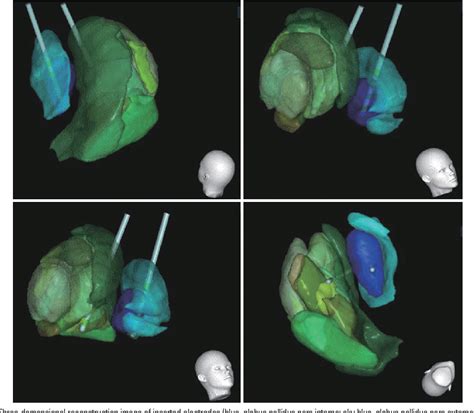 Table 1 From Dual Pallidal And Thalamic Deep Brain Stimulation For Complex Ipsilateral Dystonia