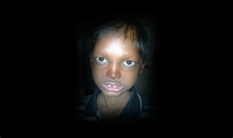 Ectodermal Dysplasia Ectodermal Defect Congenital Ectodermal