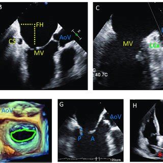 Transesophageal Echocardiogram Tee Pre Procedural Assessment And