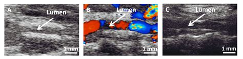 Implantation Of Inferior Vena Cava Interposition Graft In Mouse Model