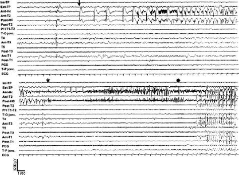 Spontaneous Mesiotemporal Seizure Recorded By Seeg I At Seizure Onset