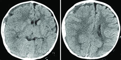 Computed Tomography On Admission Revealed The Right Subdural Hematoma