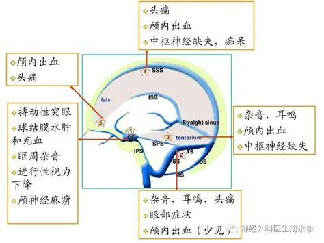 硬脑膜动静脉瘘影像学诊断 脑医汇