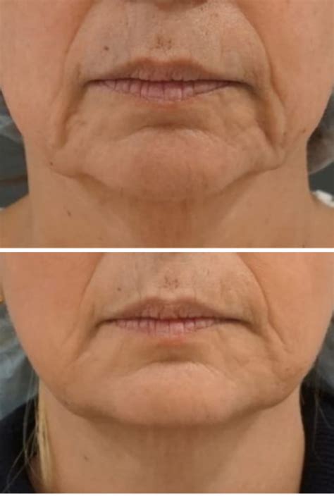 Sofwave Shot Shop Med Spa