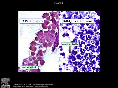 Pancreatic Lymphoepithelial Cyst Ppt Download