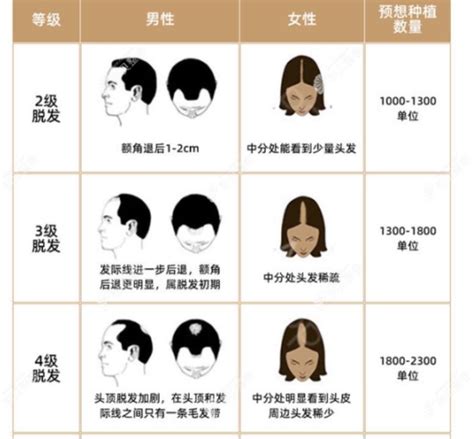 如何了解自己是几级脱发看男女头顶脱发等级解说 医美焦点 美哪里1
