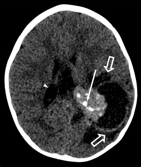 Choroid Plexus Carcinoma In A 2 Year Old Girl Nonenhanced Ct Axial Download Scientific Diagram