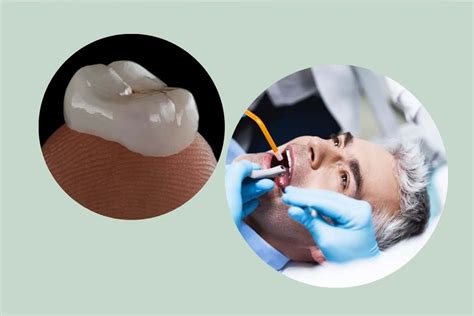 Root Canal Through Crown How It Is Performed