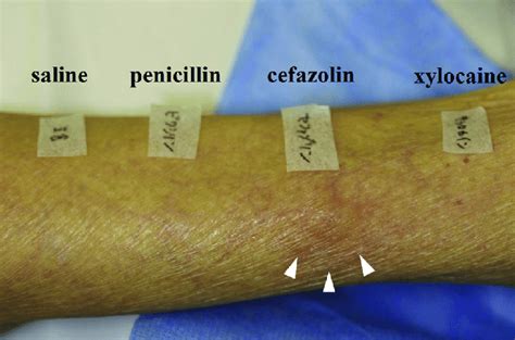 Results Of Intradermal Testing Intradermal Testing Showed A Strong Download Scientific Diagram