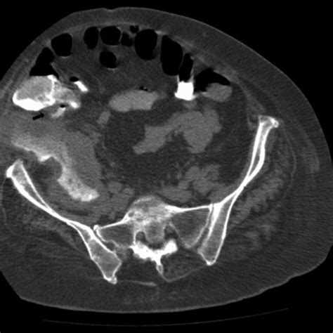 Enhanced Axial Ct Image Showing Right Psoas Muscle Abscess Download