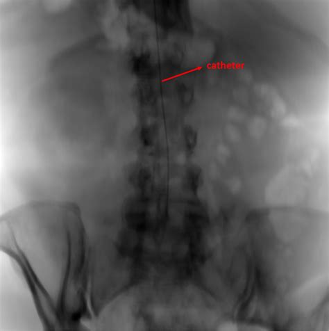 How Can I Extract Voxel Indices Of Points Along A Tubular Segmentation