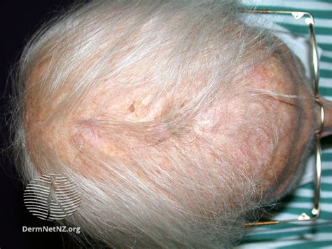 Androgenetic Alopecia Female The London Skin And Hair Clinic