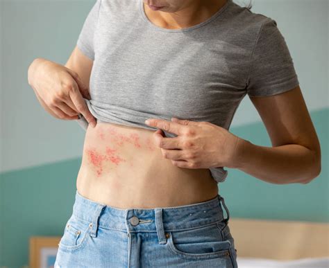 Omaha Ne Shingles Symptoms Diagnosis And Treatment Rash Experts
