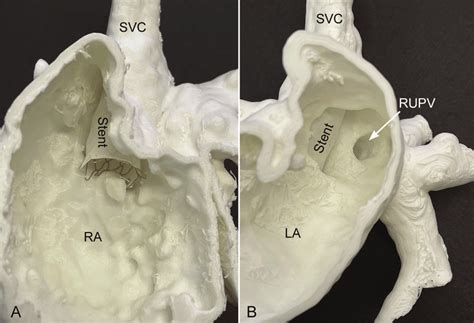 3d Printed Model Of Superior Sinus Venosus Defect Feasibility Of The Download Scientific