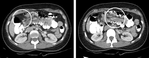 Ct Scan Of The Abdomen Performed On Admission Showing Colo Colonic Download Scientific Diagram