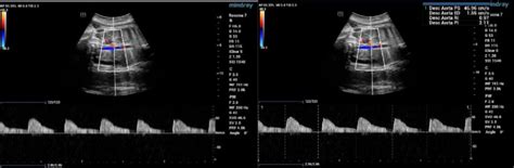 Fetal Renal Artery Doppler Imaging Download Scientific Diagram