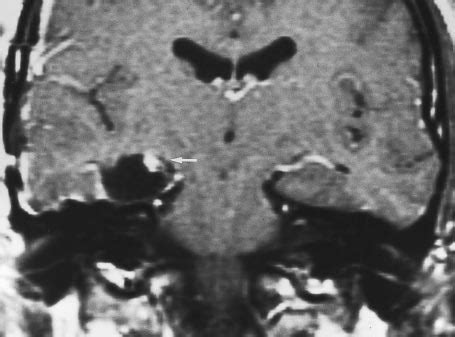 Typical Postoperative Changes Of The Choroid Plexus After Temporal Download Scientific Diagram