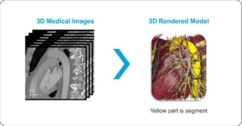 Three Dimensional Visualization And Printing Of Cardiac Anatomy For