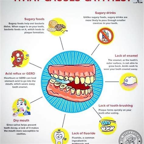 What Causes Dental Cavities Dental Cavities Tooth Decay Tooth Decay