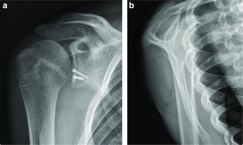 Postoperative Anteroposterior A And Lateral B Radiographs With