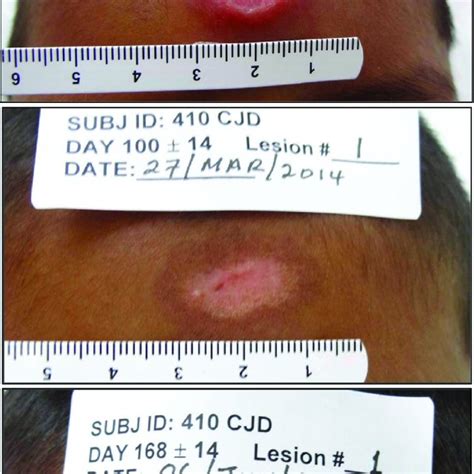 Photographs Of Lesion 1 In A Subject Treated With Paromomycin Over