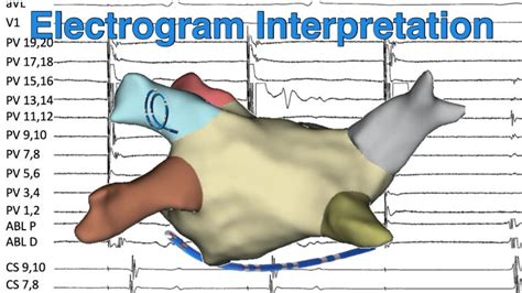 Electrogram Interpretation 16 Ep Essentials Ep Essentials Llc