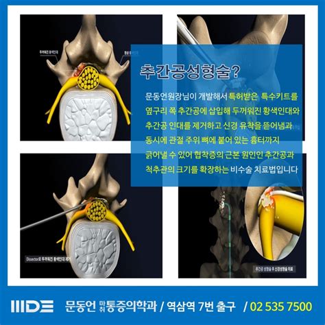 척추관협착증 비수술 치료법 추간공성형술 네이버 포스트