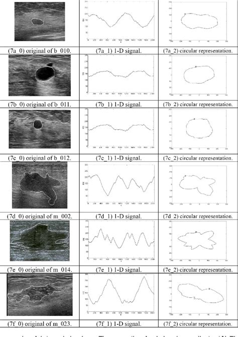 Figure 2 From Breast Tumor Classification Of Ultrasound Images Using