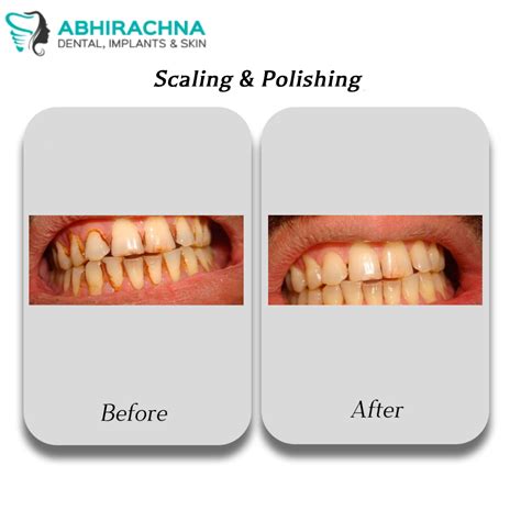Scaling And Polishing Abhirachna Dental And Aesthetics