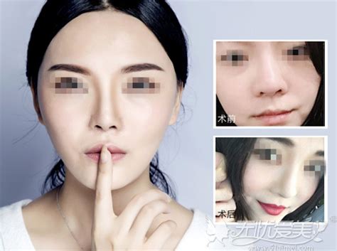 鼻翼缩小不手术 鼻翼缩小 鼻孔缩小术 大山谷图库
