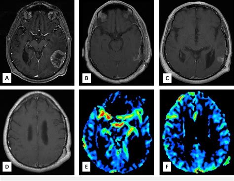 Scalp Metastasis Post Craniotomy And Radiosurgery A D Gadolinium Download Scientific Diagram