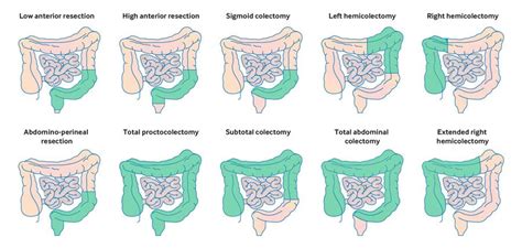 Total Abdominal Colectomy