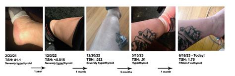 Edema Progression Over 3 Years Of Thyroid Journey Rhashimotos