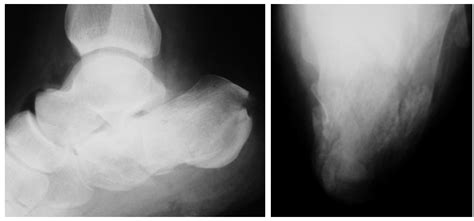 Calcaneus Fractures Trauma Orthobullets