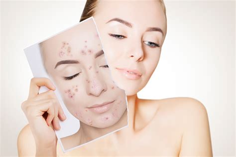 Pimpled 피부와 깨끗 한 피부 지주 초상화와 여자의 근접 촬영 초상화 가꿔주기에 대한 스톡 사진 및 기타 이미지 가꿔주기 건강관리와 의술 구멍이 많은 Istock