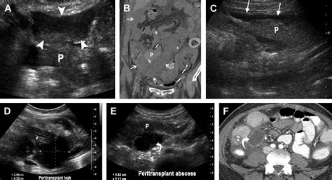 Imaging Of Pancreas Transplantation And Its Complications Radiologic