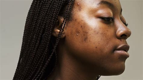 Has The Acne Positivity Movement Actually Got Us Anywhere British Vogue