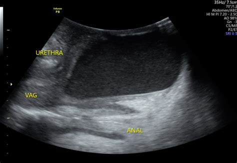 Perineal Abscess