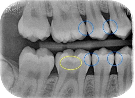What Is Caries Keith Dental Practice