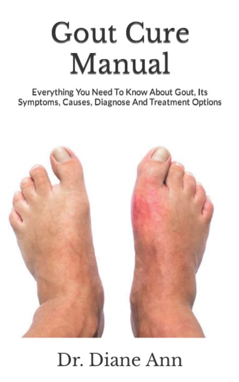 Buy Gout Cure Manual Everything You Need To Know About Gout Its